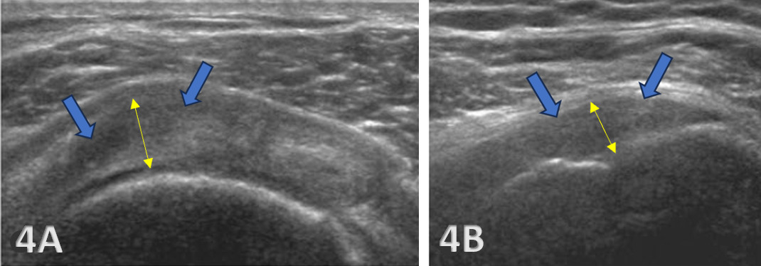 Utilizing Diagnostic Musculoskeletal Ultrasound for Assessment of the ...