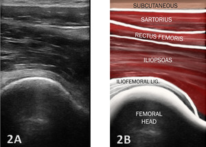 The Use of Diagnostic Musculoskeletal Ultrasound for the Evaluation of ...