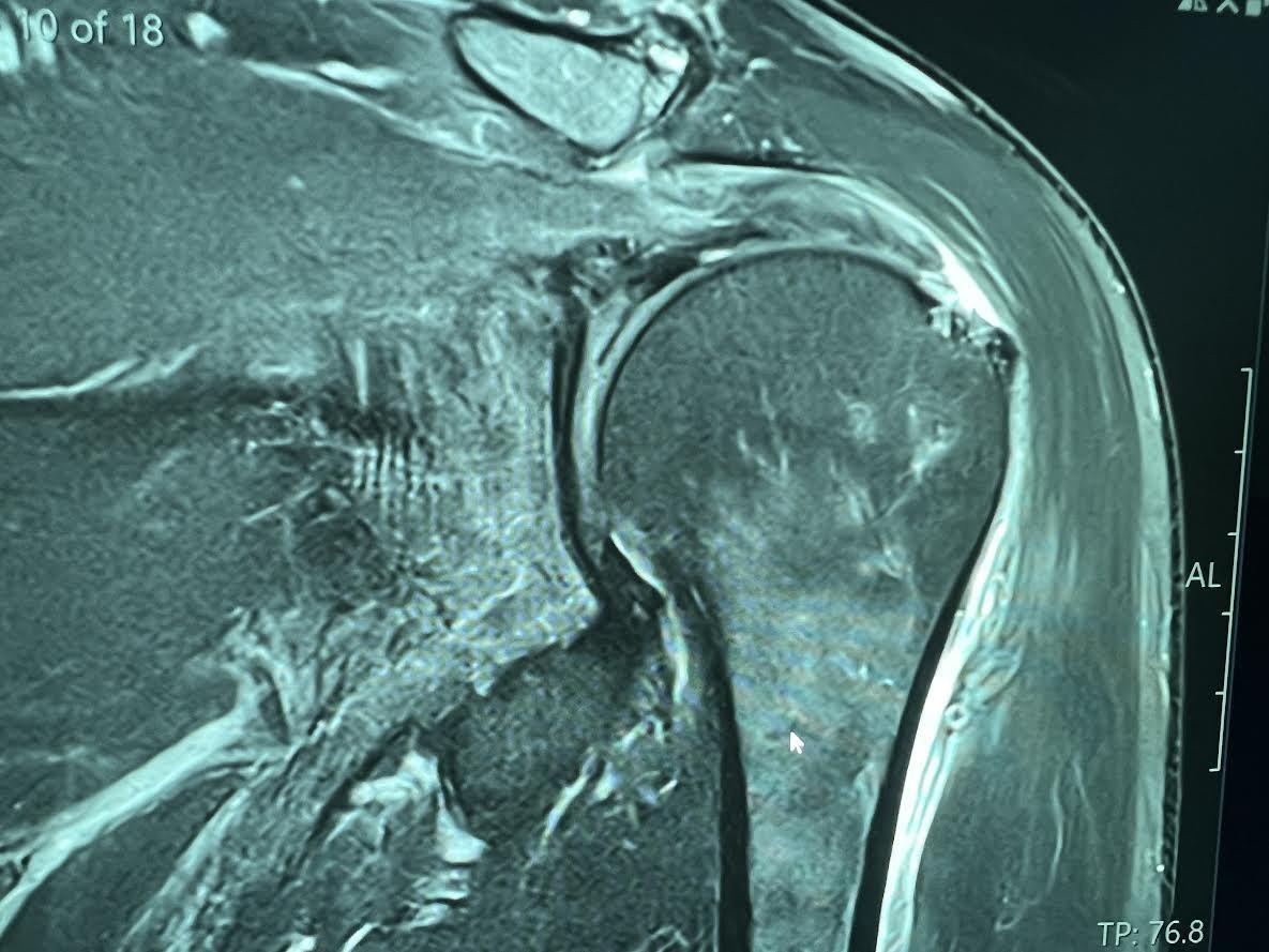 Four Common Upper Body Injuries in Tennis Players: Prevention ...