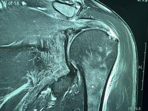 Four Common Upper Body Injuries in Tennis Players: Prevention ...