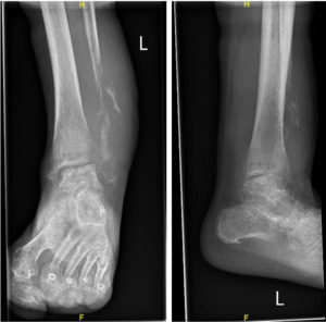 Distal Fibular Metastasis of Colorectal Carcinoma: A Case Report ...