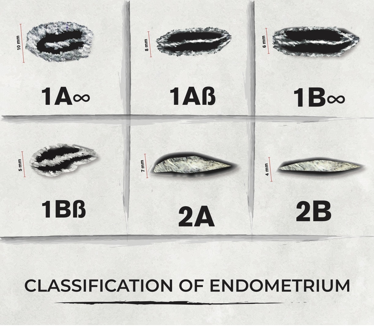 Ultrasonographic Endometrial Classification In In Vitro Fertilization