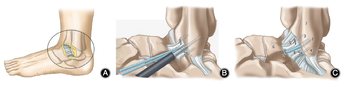 COMBINATION OF MODIFIED BROSTRÖM PROCEDURE AUGMENTATED WITH ...