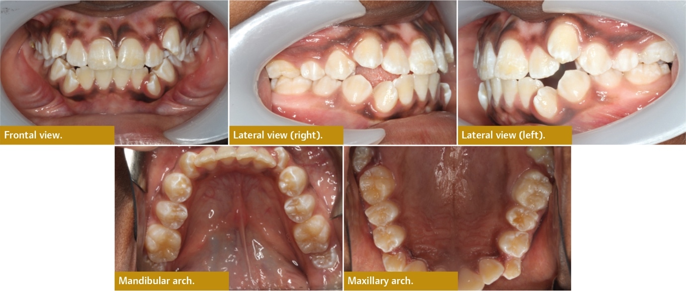 An inflammatory Odontogenic Cyst (Unusual Case): A case report ...