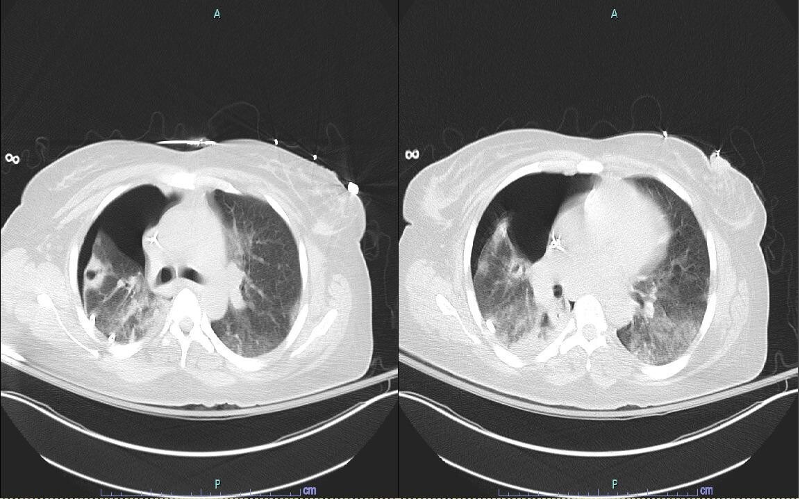 Pseudomonas aeruginosa Infection Presenting as Microangiopathic ...