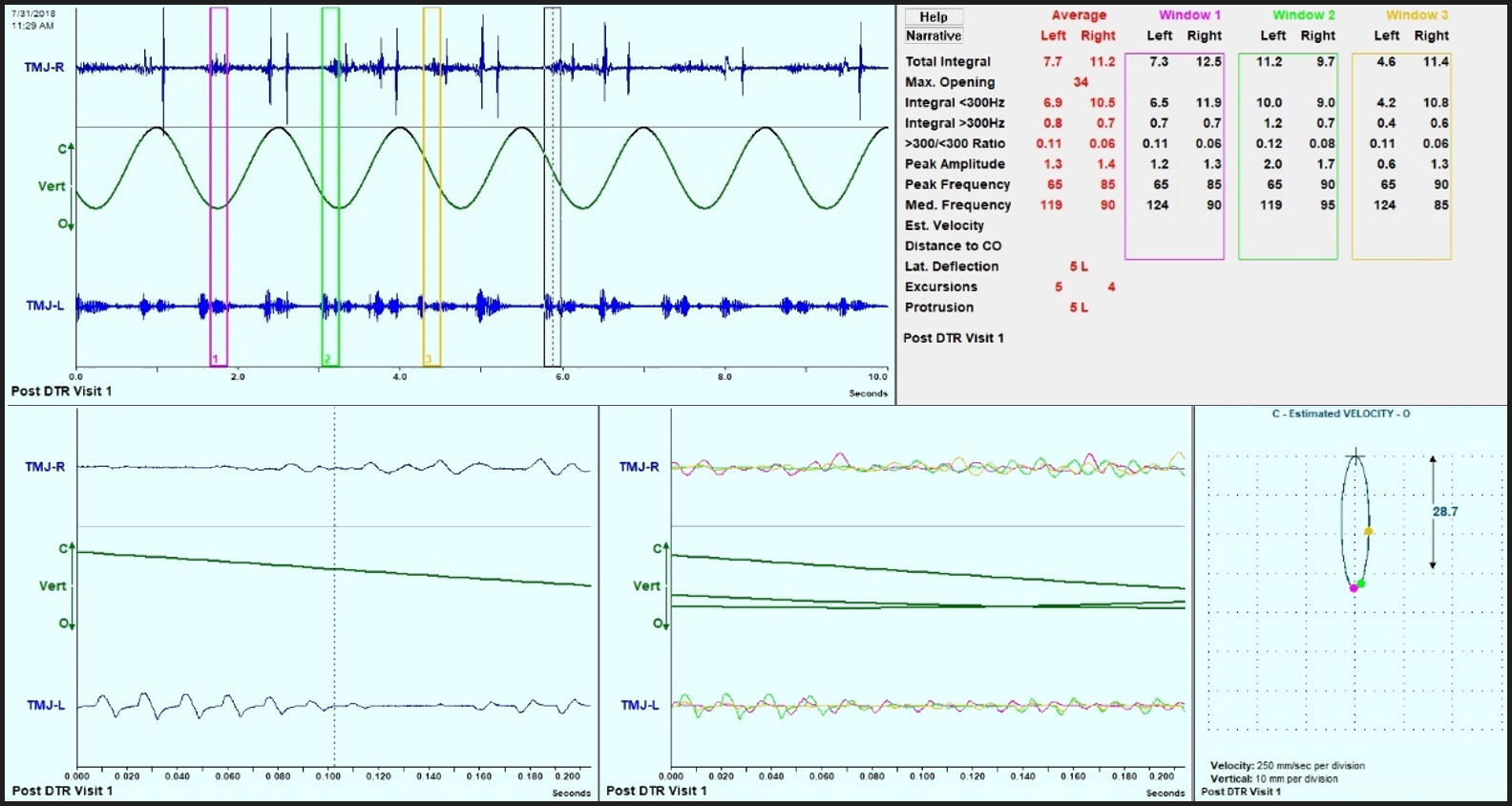 Meniere’s Disease Patients Treated with Disclusion Time Reduction: TMJ ...