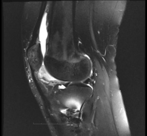 Intra-Articular Nodular Fasciitis of the Knee, A Rare Clinical Presentation and Histological ...