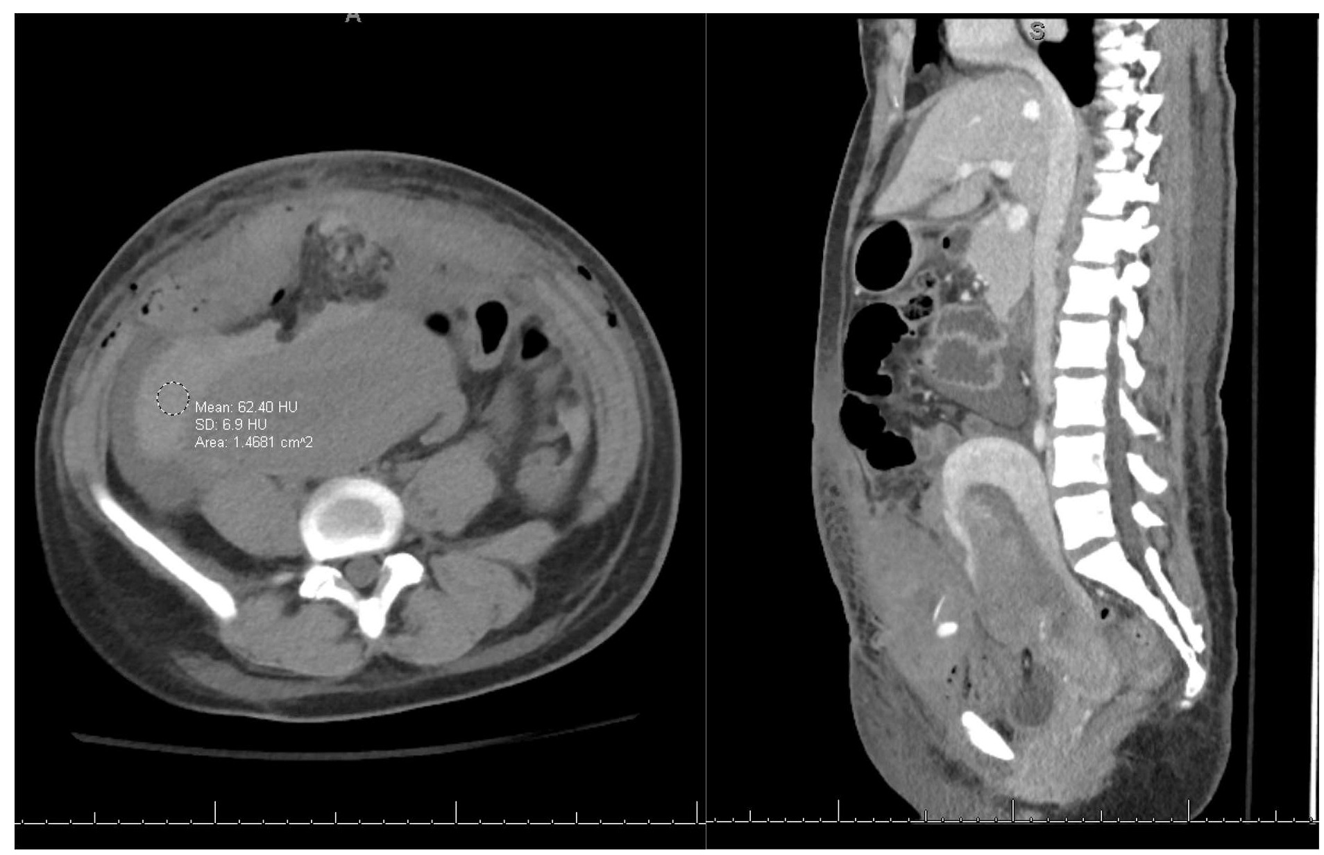 Rectus Abdominis Sheath Hematoma Following Cesarean Section: A Case ...