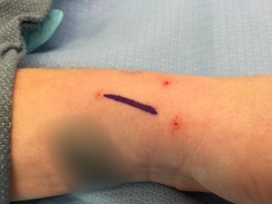 Prevention of Tendon Subluxation in Dequervain's Tenosynovitis Release ...