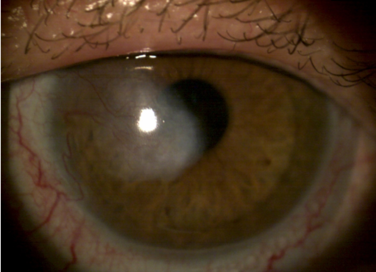 Point-Counter Point: Treating Corneal Haze with 0.8 mg/mL Topical ...