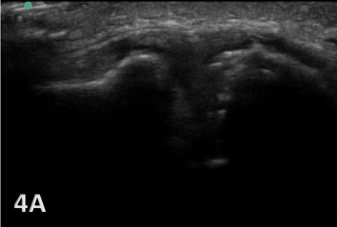 MSK Diagnostic Ultrasound for the Assessment of the Acromioclavicular ...