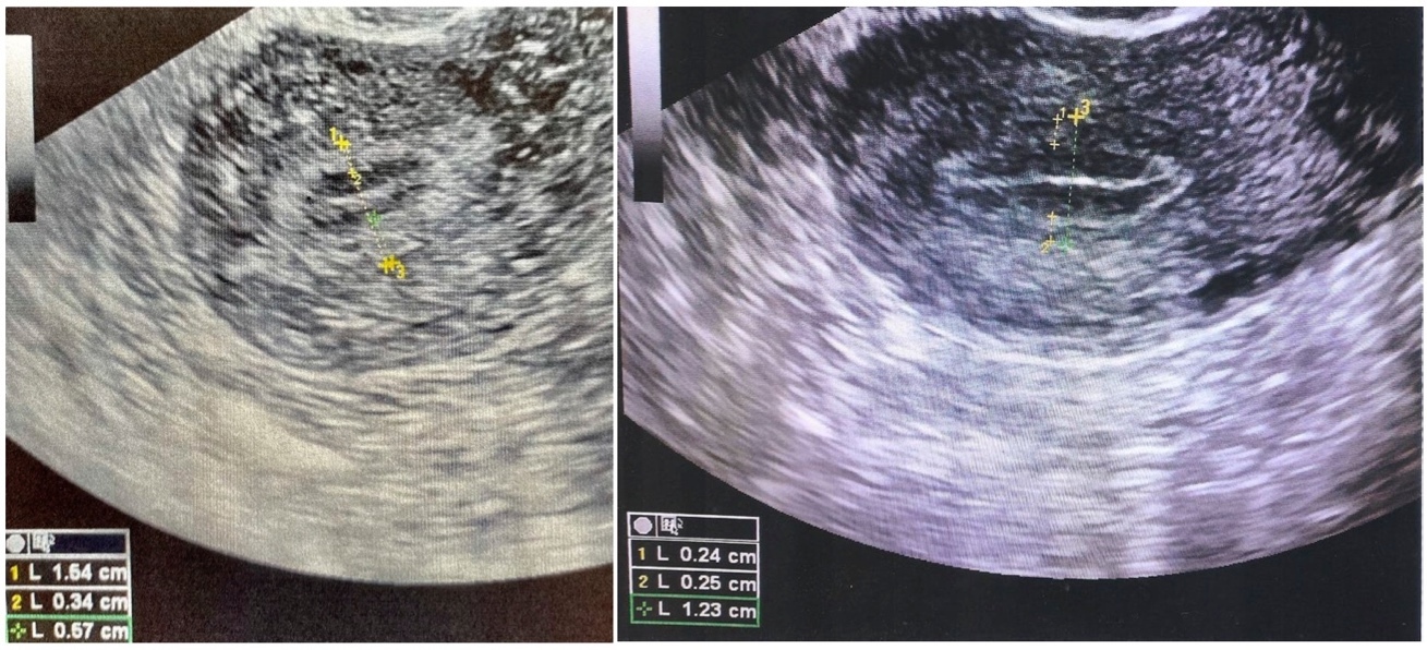 Ultrasonographic Endometrial Classification In In Vitro Fertilization