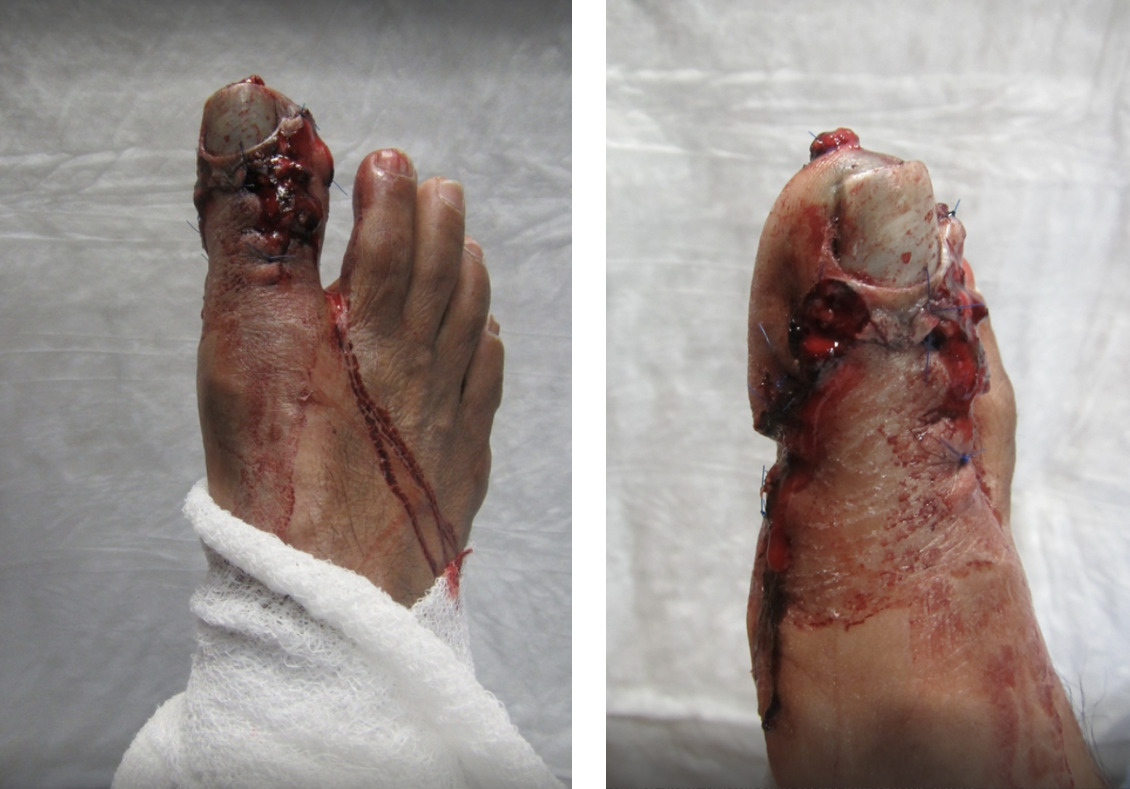 Traumatic Hallux Fracture | Published in Orthopedic Reviews