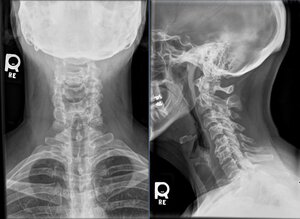 TREATING SECONDARY SYMPTOMS OF EHLERS-DANLOS SYNDROME: A CASE REPORT ...