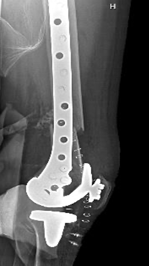 Early Weight Bearing after Distal Femur Fractures in the Elderly: A ...