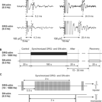 DRG stimulation - synchronized nerve and DRG