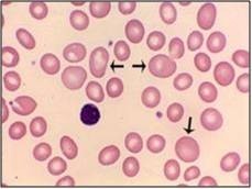 Anemia, Macrocytic