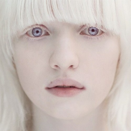 Skin Color; Albino, the fairest of them all ! | Albino girl, Albinism ...