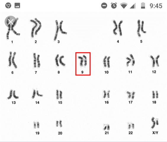 EVOLUCIÓN DE LOS SÍNDROMES POR ALTERACIONES CROMOSÓMICA timeline | Tim