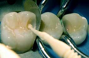 La Evolución de la Odontología Restauradora timeline | Timetoast