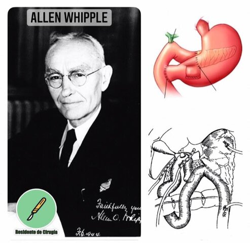 Historia pancreatoduodenectomia timeline | Timetoast timelines