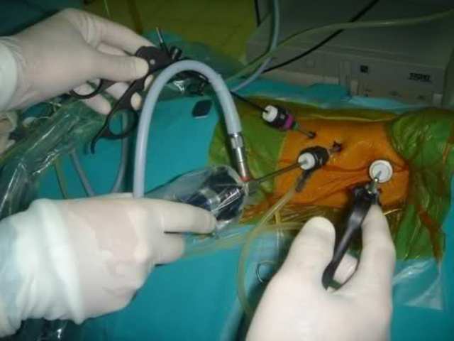 LAPAROSCOPIA timeline | Timetoast timelines