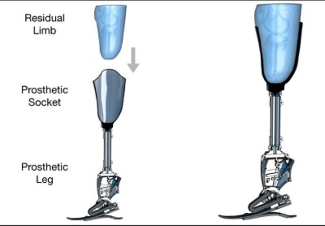 Timeline of Prosthetics | Timetoast timelines