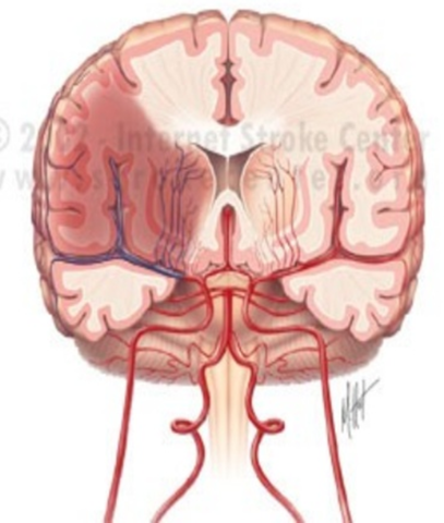 Fisopatología del EVC timeline | Timetoast timelines