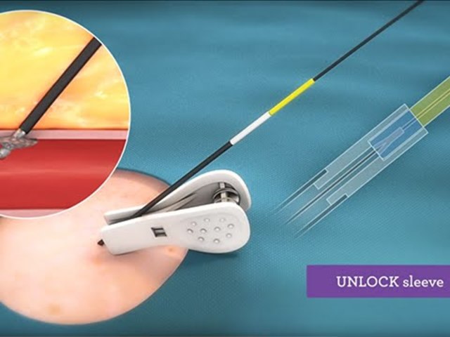 Historia de los dispositivos de cierre vascular timeline | Timetoast ...