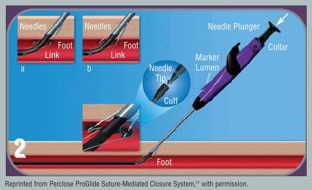 Historia de los dispositivos de cierre vascular timeline | Timetoast ...