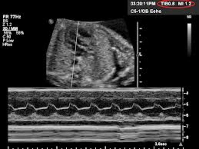 history of Ultrasound timeline | Timetoast timelines