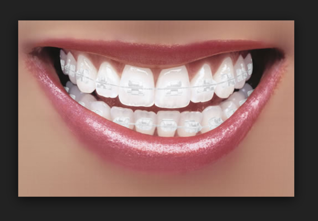 History Of Braces Timeline Timetoast Timelines