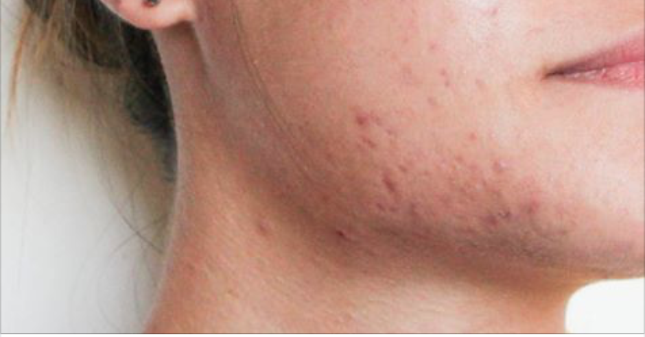 Does Alcohol Cause Acne Breakouts? Here's What Research Shows