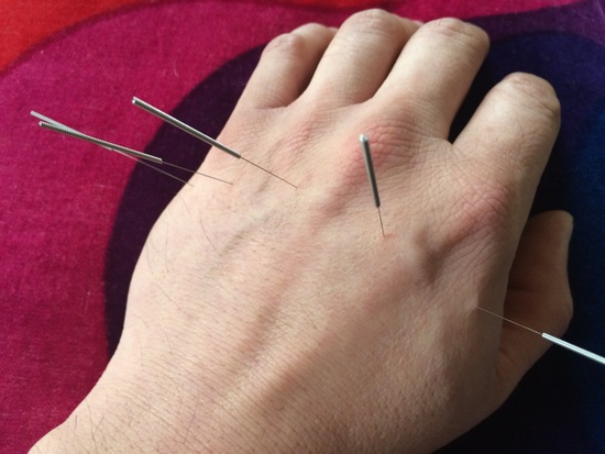 Acupuncture to Relieve Neck Pain - Tona Healing