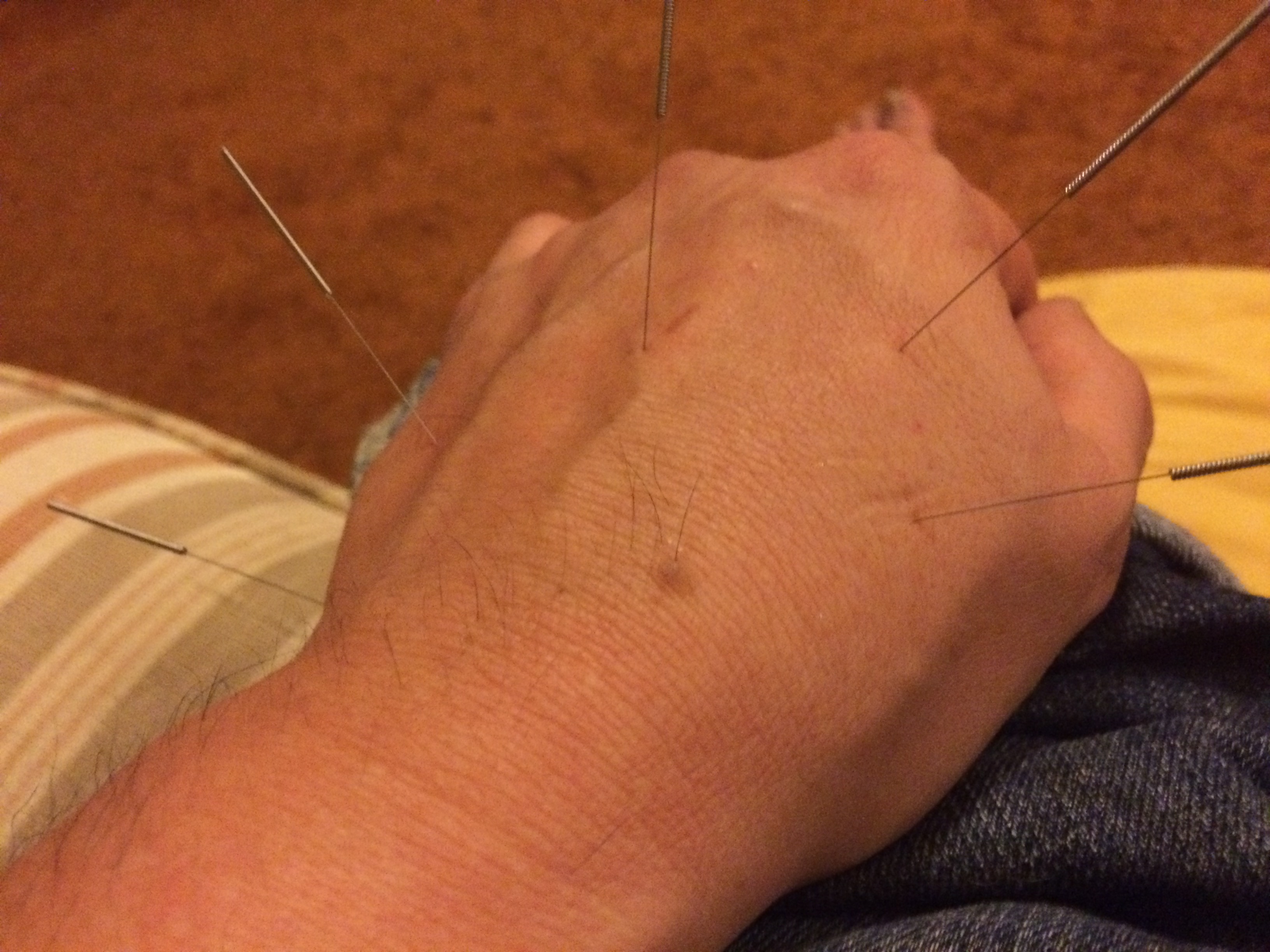 acupuncture for backache