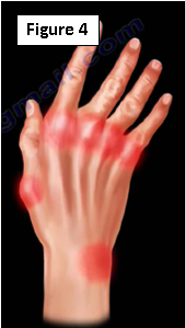 Common Hand and Finger Problems - Thrive Global