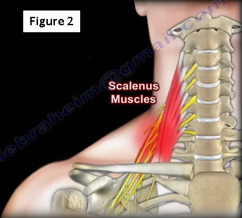 Thoracic Outlet Syndrome - Thrive Global