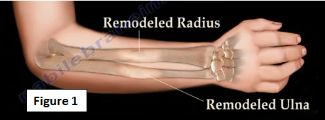 Fractures and Bone Remodeling in Children - Thrive Global