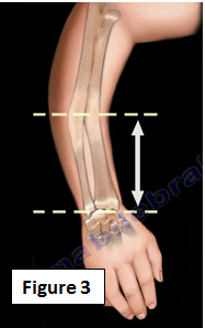 Fractures and Bone Remodeling in Children - Thrive Global
