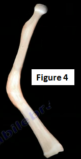 Fractures and Bone Remodeling in Children - Thrive Global