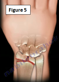 Fractures and Bone Remodeling in Children - Thrive Global