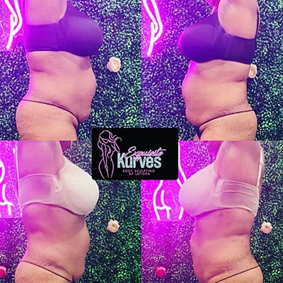 Exquisite Kurves Offers Body Sculpting in Bakersfield, CA 93301