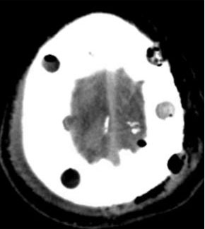 Endovascular :: Moyamoya Syndrome