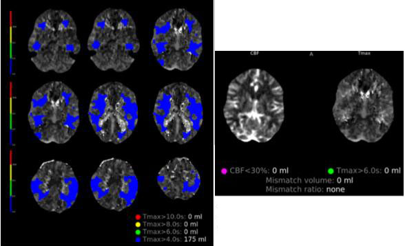 Endovascular :: Moyamoya Syndrome