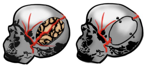 Endovascular :: Moyamoya Syndrome