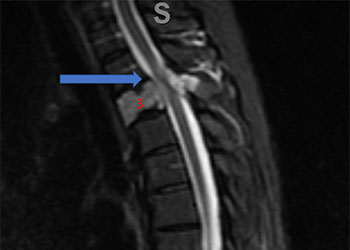 T3 Hemangioma Compresses Thoracic Spinal Cord