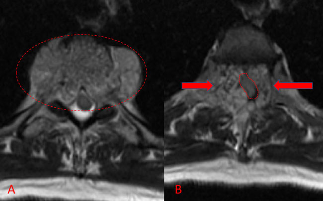 T3 Hemangioma Compresses Thoracic Spinal Cord