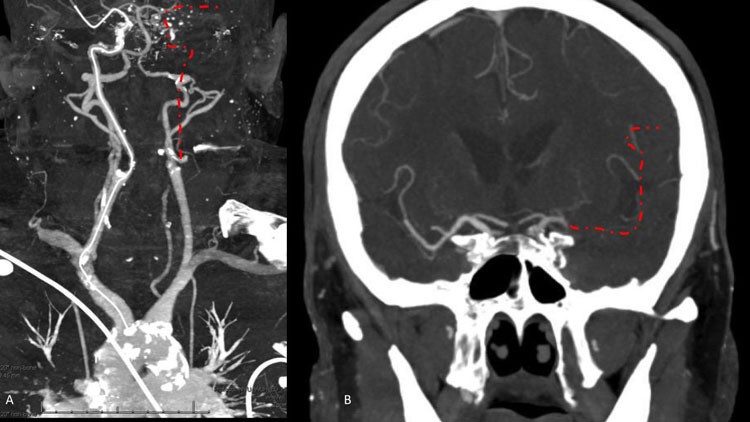 Endovascular :: Early Neurologic Decline in Tandem Carotid and MCA ...