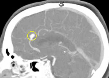 Endovascular:: Mycotic Aneurysm of the Brain