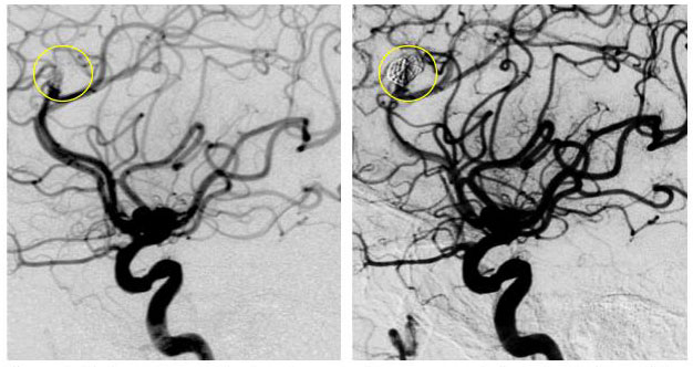 Endovascular:: Mycotic Aneurysm of the Brain